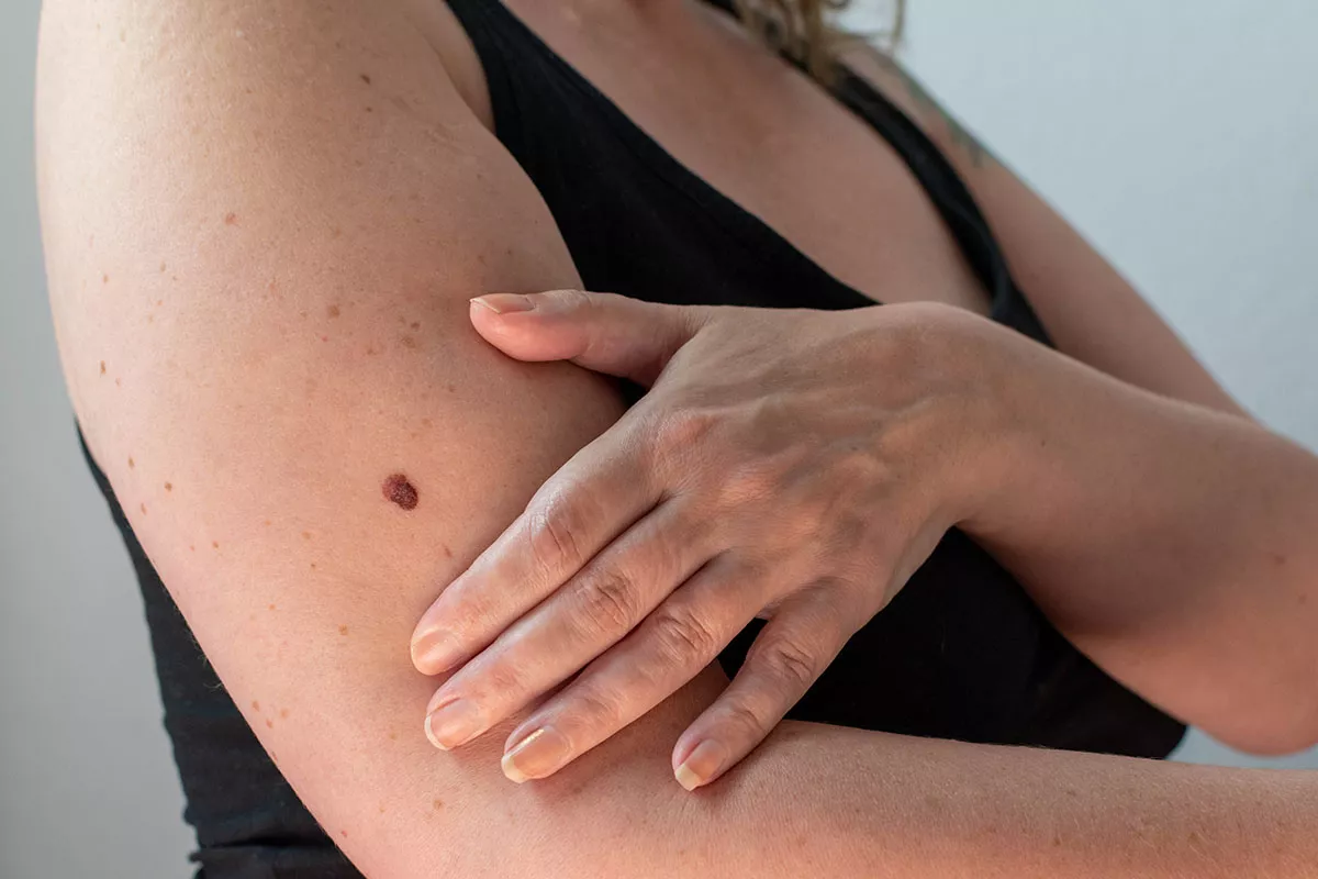Lumps, Bumps & Skin Lesion Removal | Book A Skin Consultation